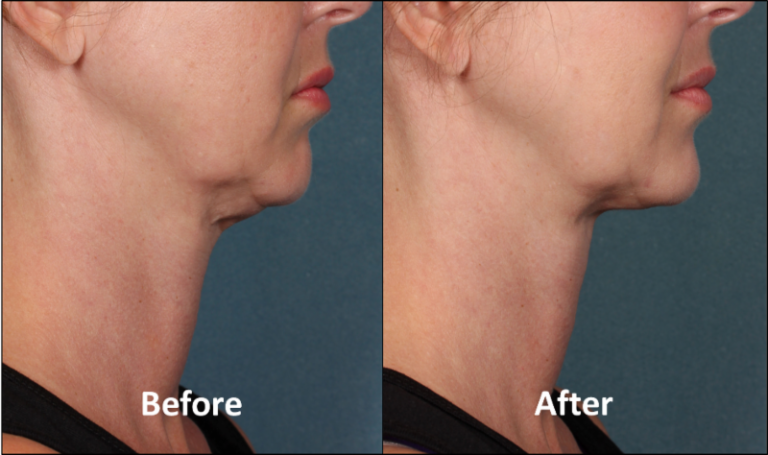 Kybella-Before-and-After-Photos - Newport Medical and Wellness